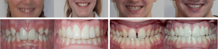 Missing Lateral Incisors | Ethos Orthodontics