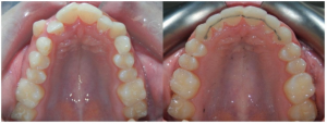 Palatal Expansion Treatments - Palatal Expanders - Ethos Orthodontics