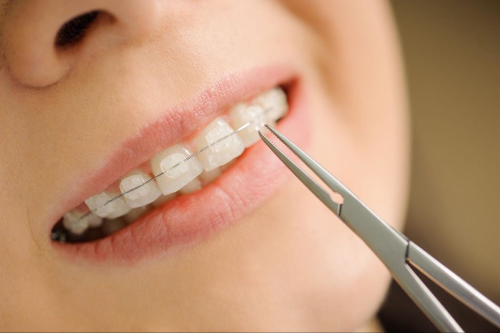 Which Braces Are Right For Your Teeth? - Ethos Orthodontics
